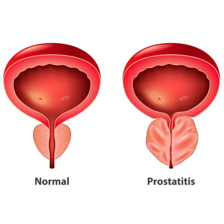 UNDERSTANDING PROSTATITIS AND HOW HERBAL MEDICINE TACKLES IT. – Toshma ...